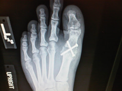 Journey: Big Toe Fusion--Live Surgery Results