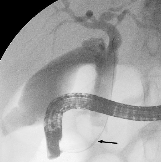 Endoscopía digestiva, vías biliares y páncreas: Obstrucción distal de ...