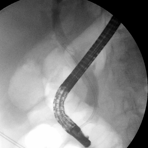 Endoscopía digestiva, vías biliares y páncreas: Obstrucción distal de ...