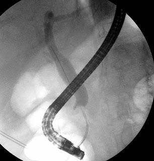 Endoscopía digestiva, vías biliares y páncreas: Obstrucción distal de ...