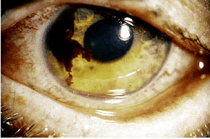 ALBAHAR EYE CASUALTY