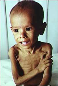 desnutrición infantil: introduccion