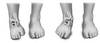 A enfermeira na casa: Diferencias y relación entre torceduras ...