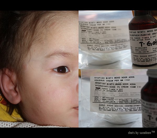 Amazing Syafiah & Co.: Allergic - Urticaria