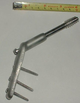 The Latest Update: Day 2 - Post #4 - The broken hip