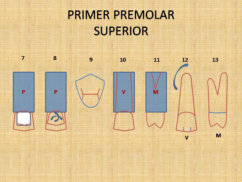 Odontogye: Tallado del primer premolar superior