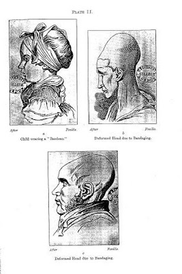 PICS DOT COM: Deformation of the Human Skull