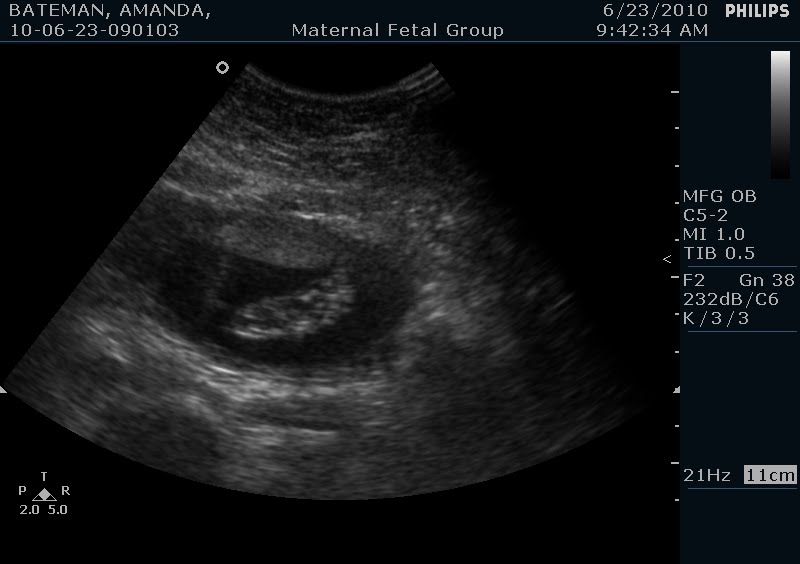 Two Jacks and a Golden: Baby Bateman's 19 1/2 Week Sonogram