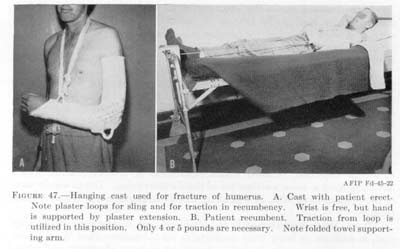 Hanging Arm Cast For Humerus Fracture