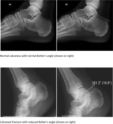 Orthopaedics Mcqs Postgraduation entrance preparation: 74 - Bohler's ...