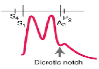 Medicine Mcqs Postgraduation preparation: 179 - Pulsus Bisferiens