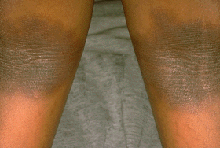 Esteliq: Eczema