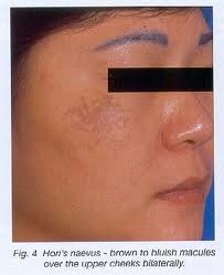 Esteliq: Hori's Nevus