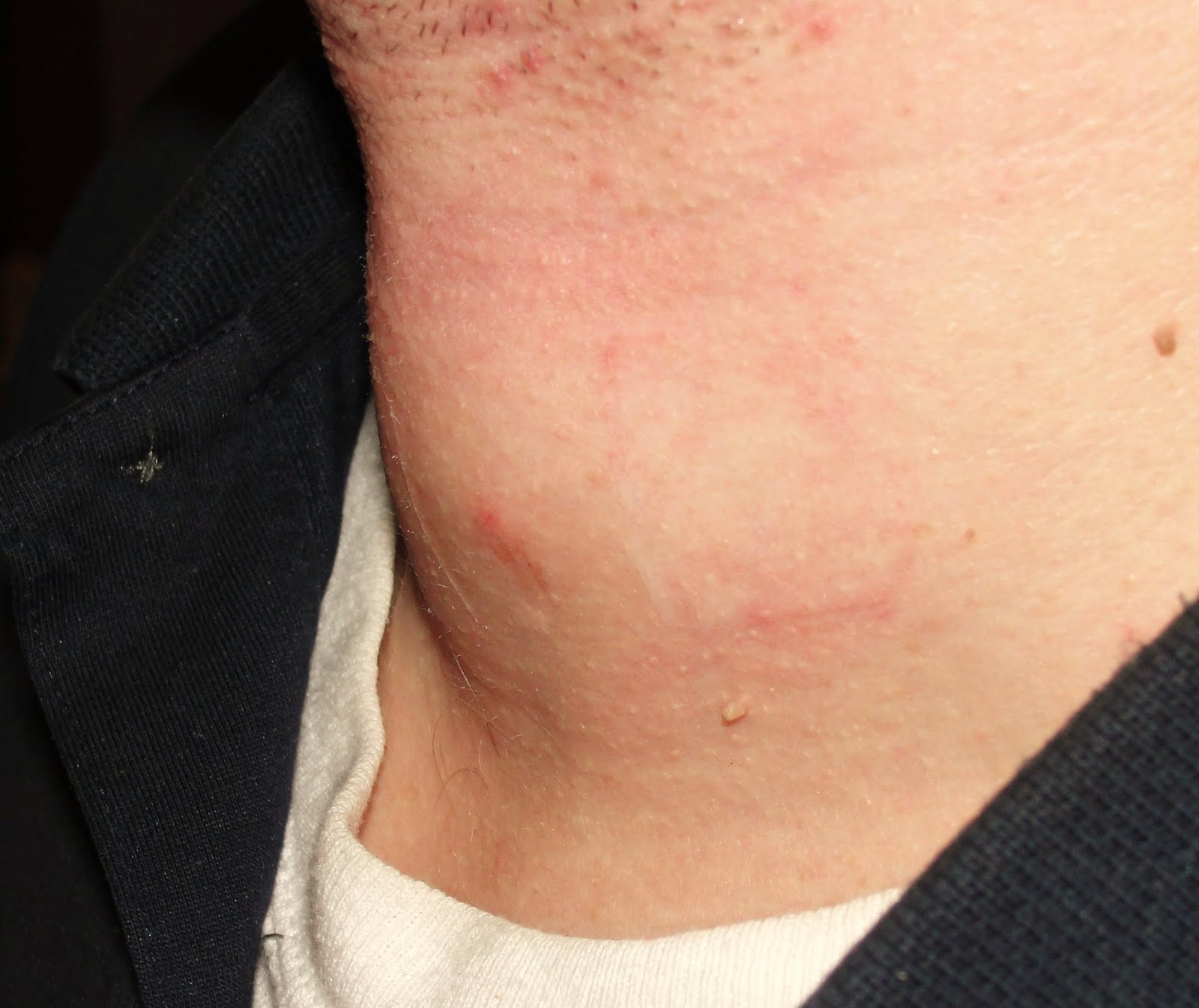 Top 98+ Pictures Thyroid Rash On Neck Photos Updated