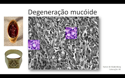 Patologia Básica: Degeneração mucosa