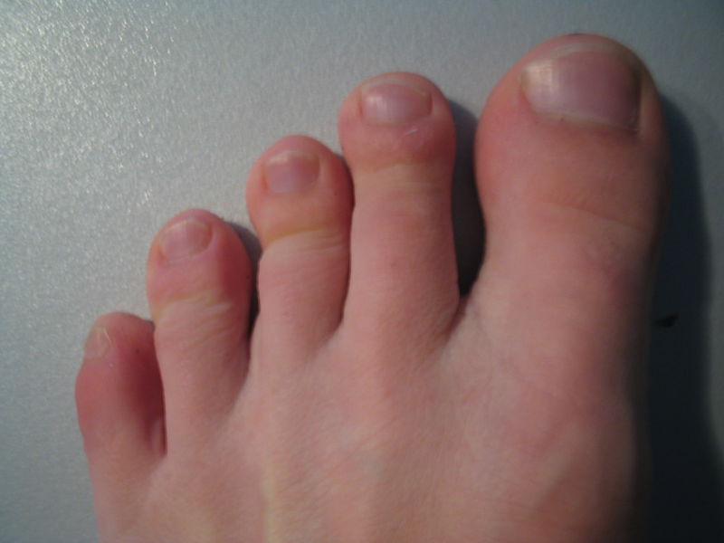 A View from the Edge: Crooked Toesies