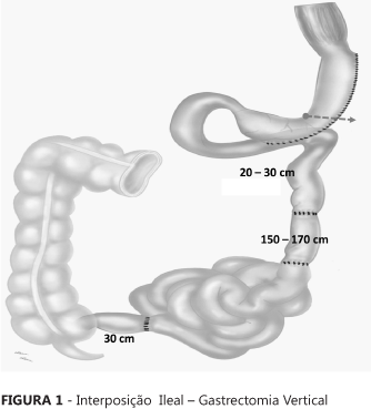 LAEC: Aspectos técnicos da interposição ileal com gastrectomia vertical ...