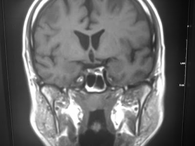 Daily Dose: Tornwaldt' cyst