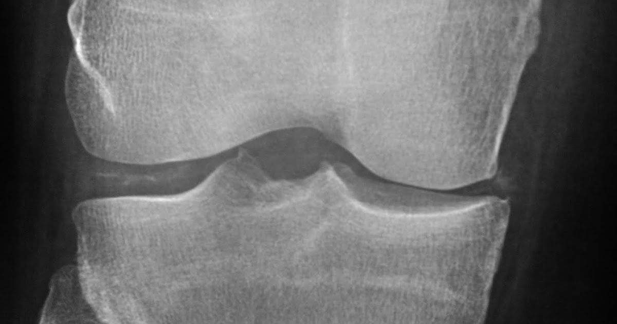 Daily Dose: Chondrocalcinosis knee