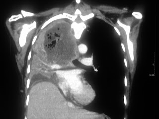 Daily Dose: Necrotic lung mass