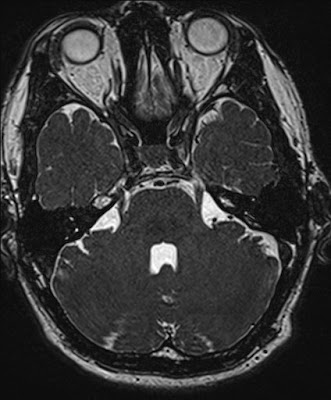 Daily Dose: Trigemianal Nerve (cisternal component)