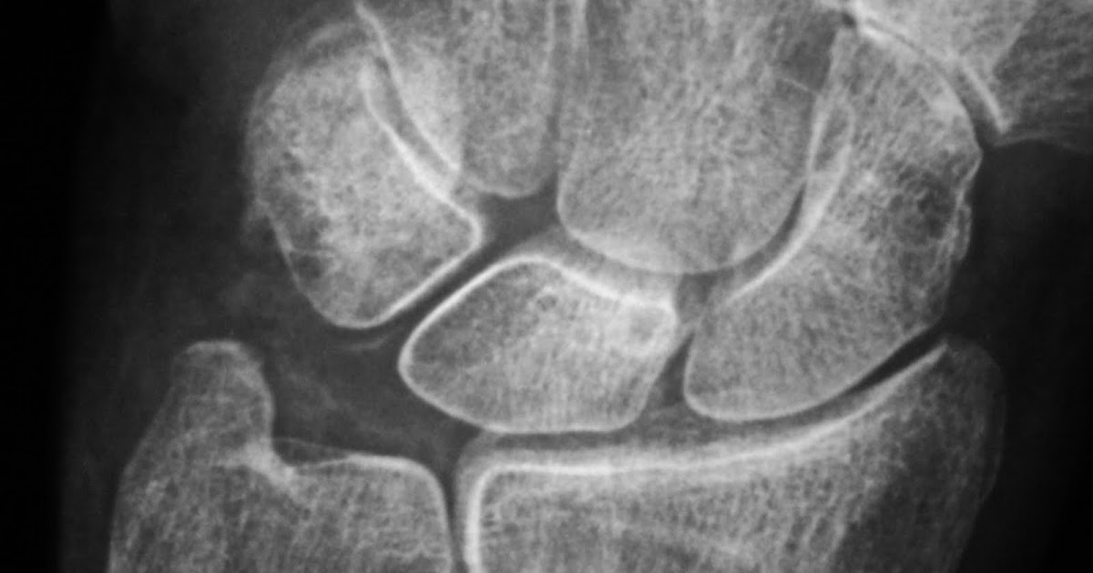 Daily Dose: Chondrocalcinosis of wrist