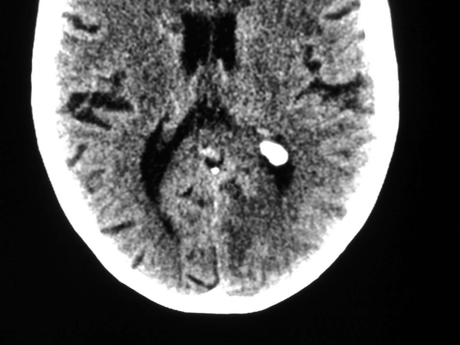 Daily Dose: PCA infarct
