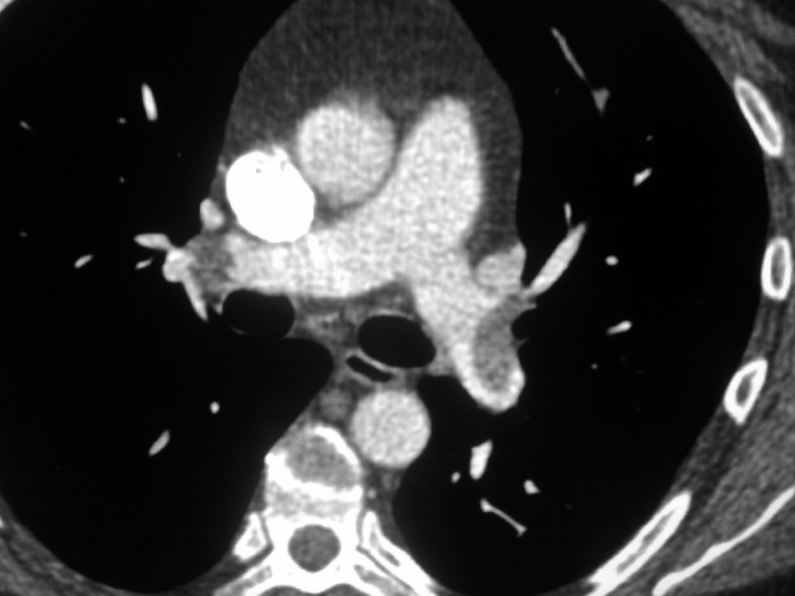 Daily Dose: Right ventricular strain in PE