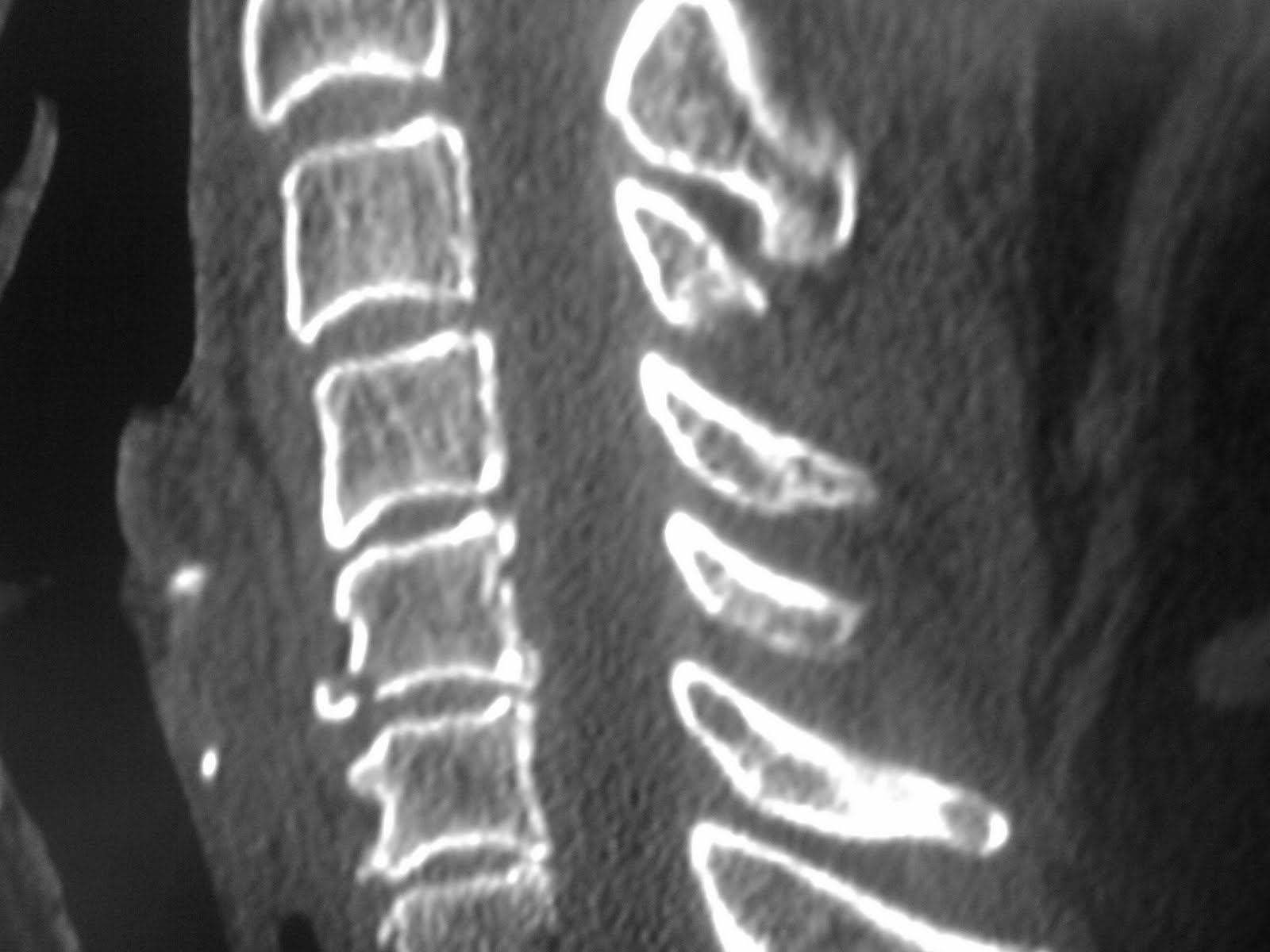 Daily Dose: Tear drop fracture