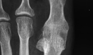 Daily Dose: Fusion of 1st MTPJ.