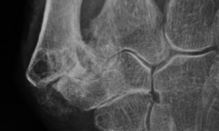 Daily Dose: Advanced osteoarthritis of 1st CMCJ