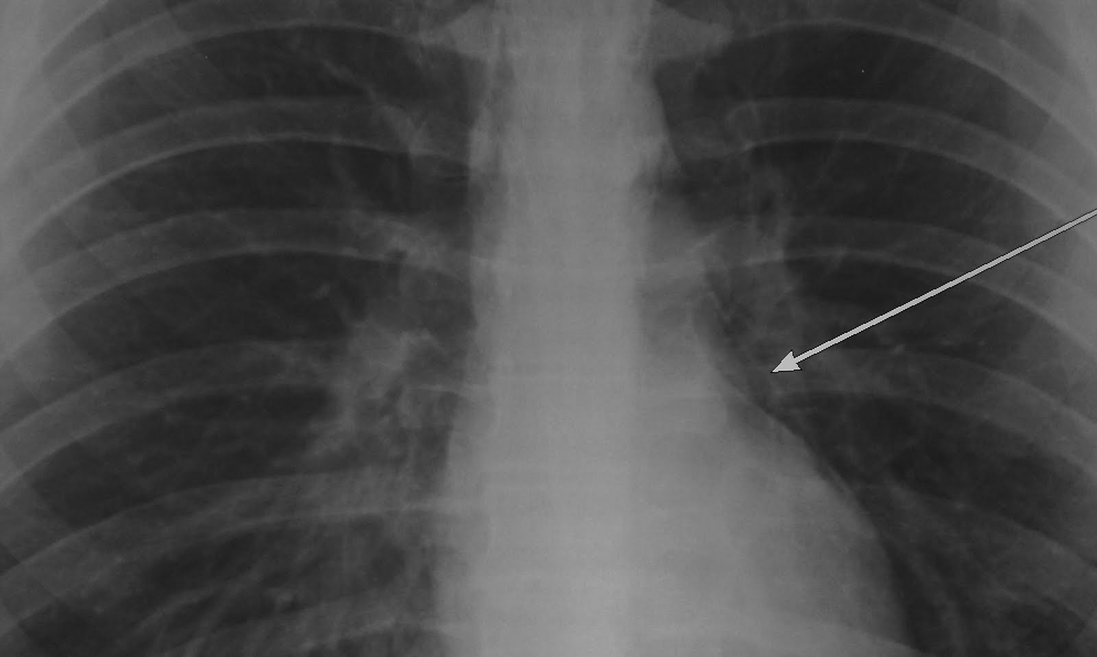 Daily Dose: Pneumomediastinum