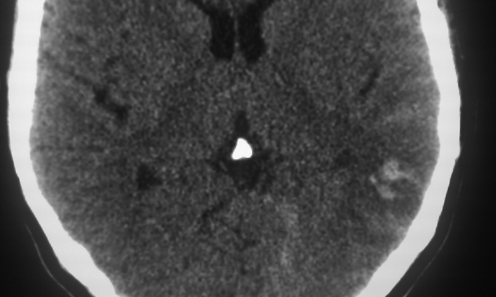 Daily Dose: Cortical venous sinus thrombosis