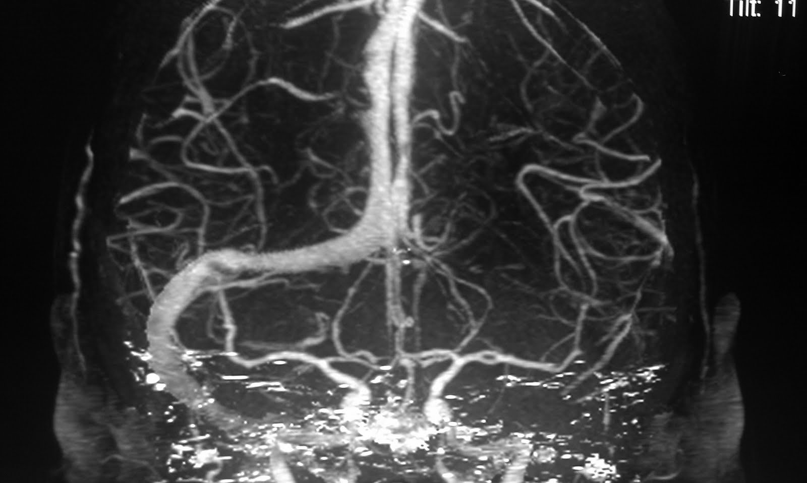 Daily Dose: Cortical venous sinus thrombosis