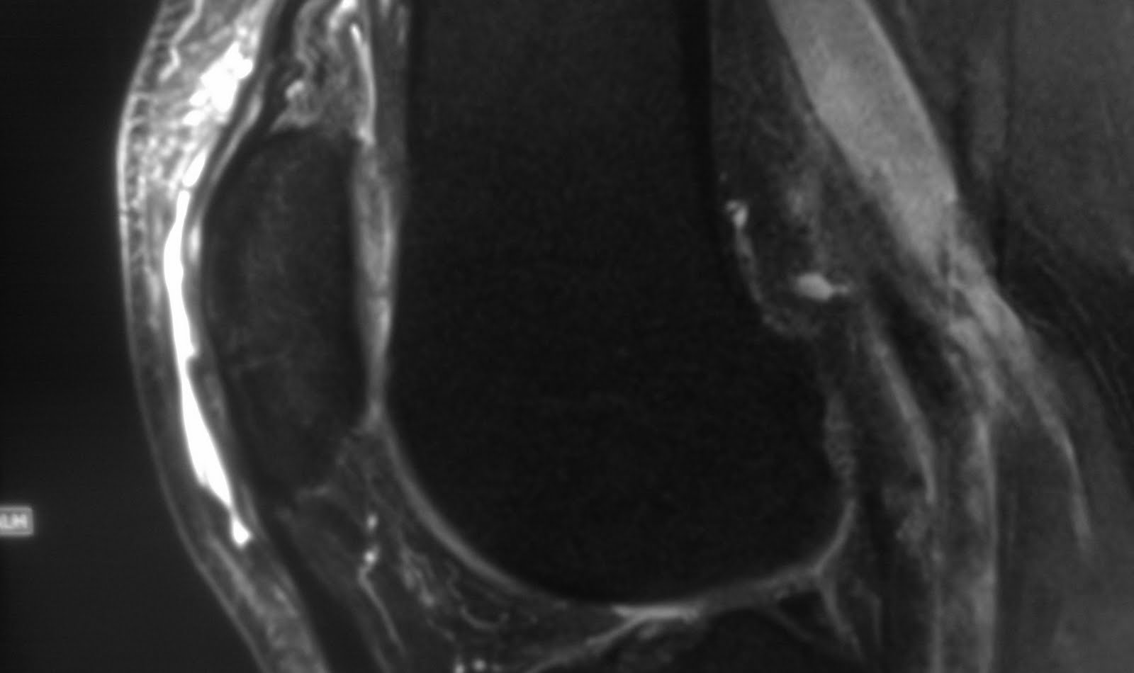 Daily Dose: Prepatellar bursitis