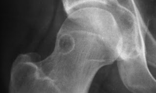 Daily Dose: Synovial herniation pit