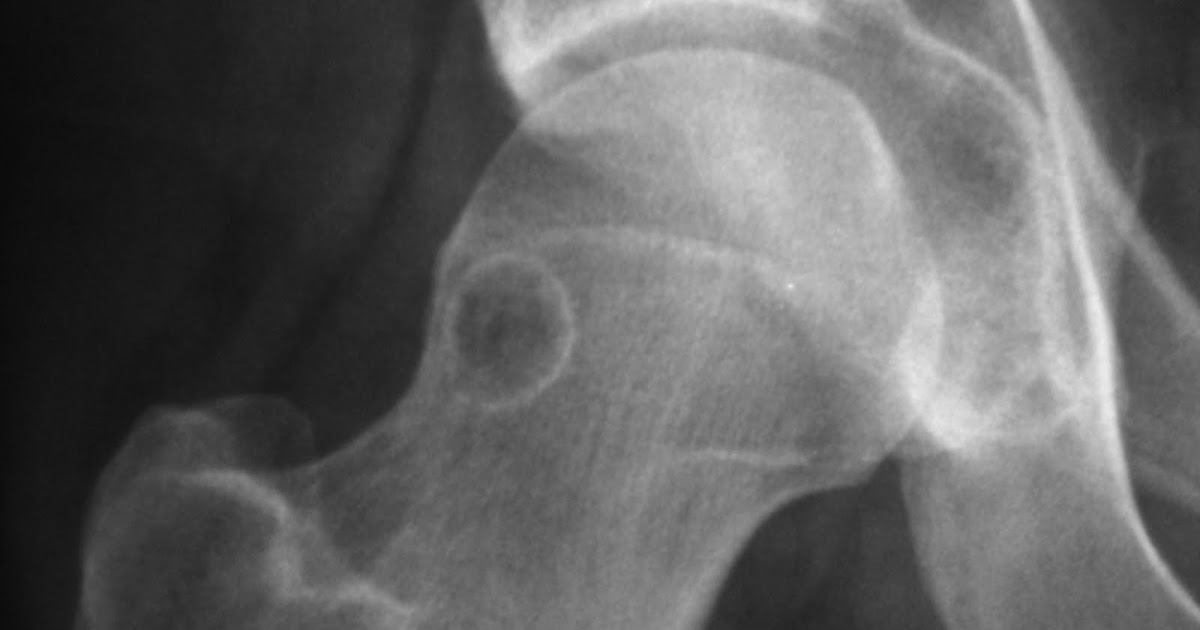 Daily Dose: Synovial herniation pit