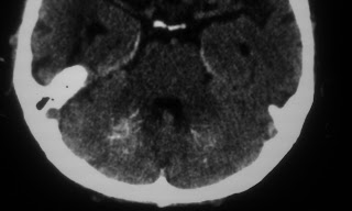 Daily Dose: Fahr's disease