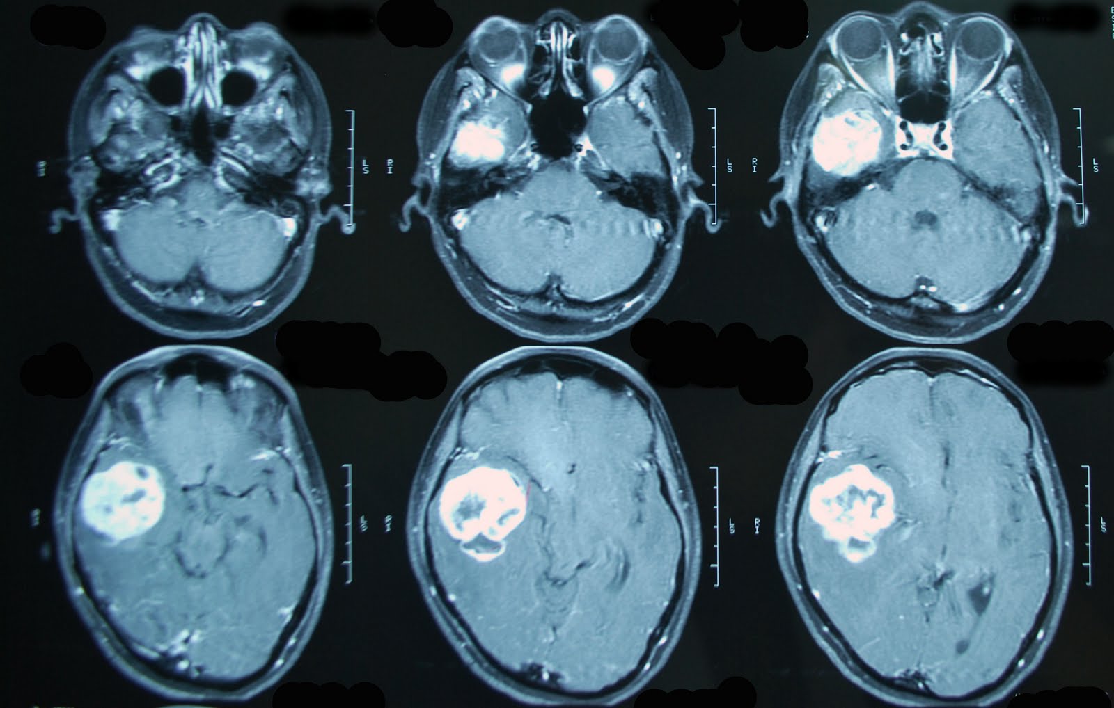 DIFFERENTIALS: CRANIECTOMY WITH EXCISION OF TUMOR MASS