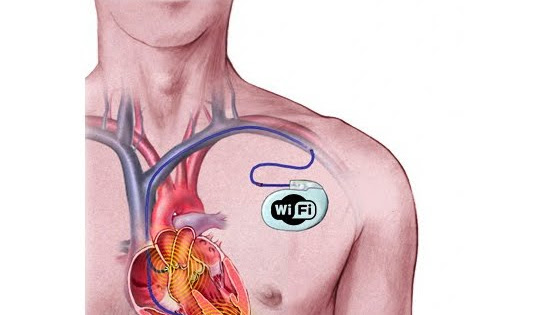 Marcapasso transmite dados via conexão sem fio | Brasil Acadêmico