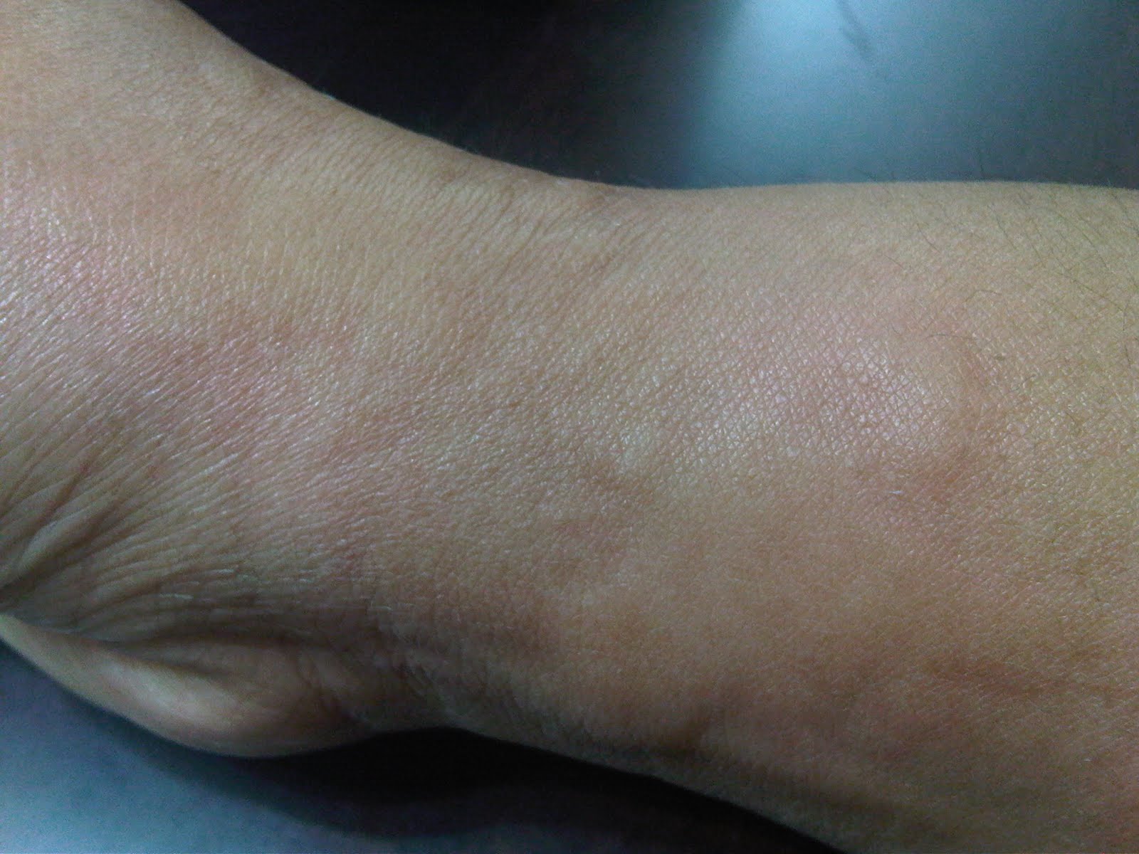 EZZE Rules: Gegata - Penyakit kegatalan