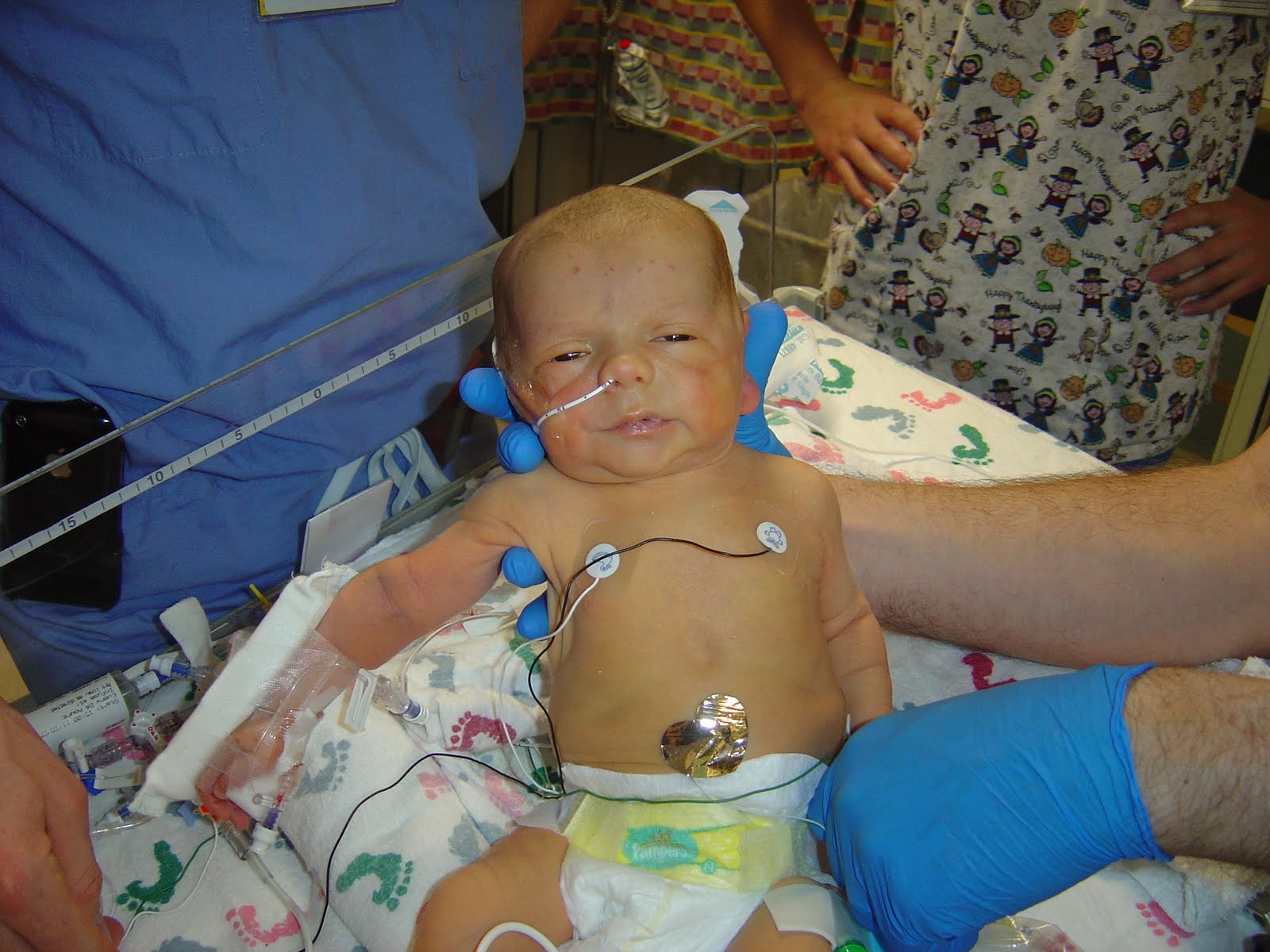 Klein Family: PICU - Day 5 - Extubated!