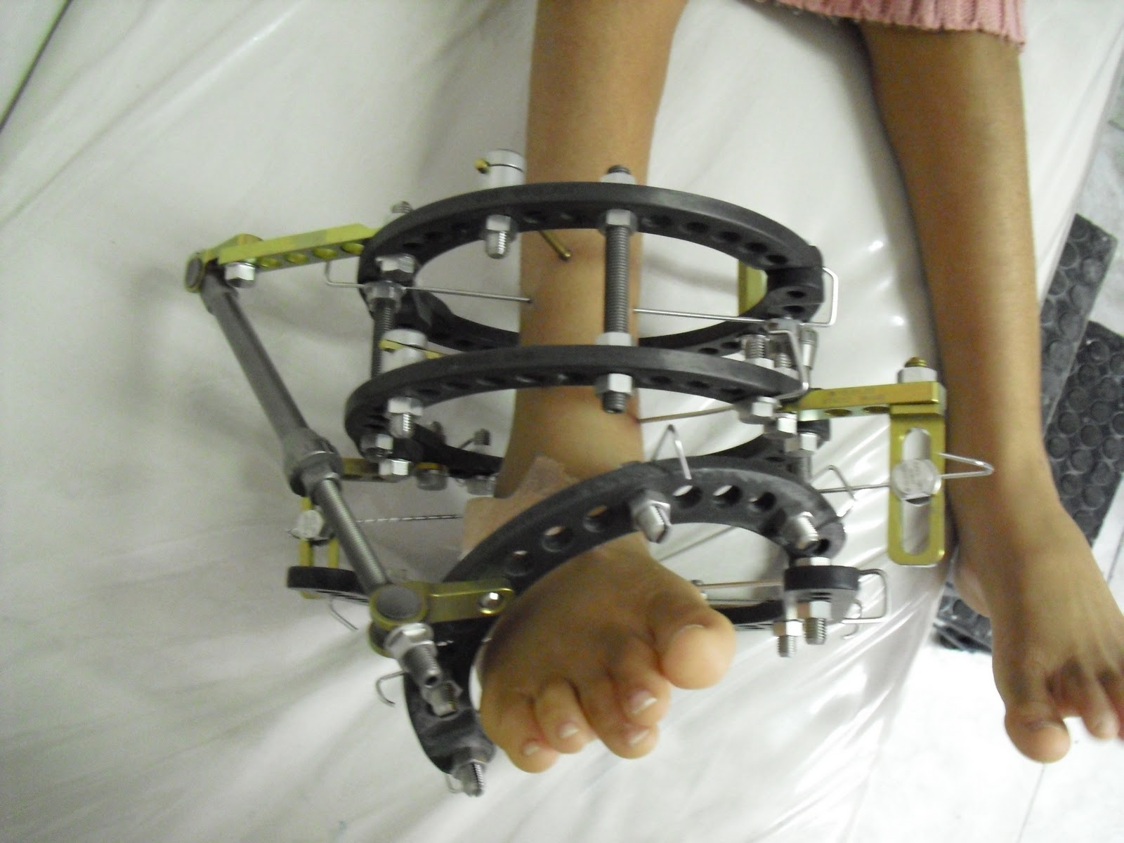 DR. CELSO RIZZI: Correção do pé torto congênito inveterado e recidivado ...