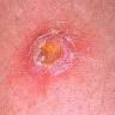 Frugal Finance: An Overview of MRSA