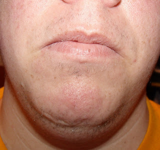 This & That: More on PCOS