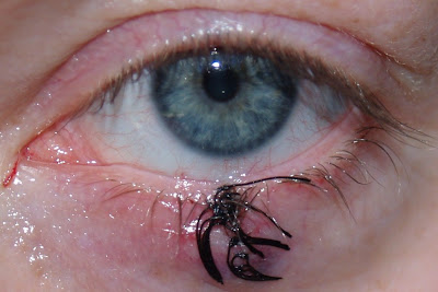 red thread: WARNING ~ Gross eye pictures!!
