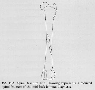 Spiral fracture causes - Julipedia