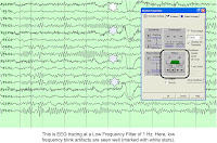 NEUROLOGY INVESTIGATIONS: FILTERS