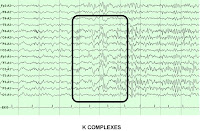 NEUROLOGY INVESTIGATIONS: ELEMENTS OF NORMAL SLEEP ACTIVITY - K COMPLEXES