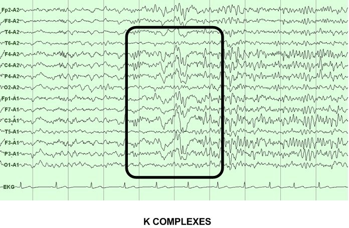 NEUROLOGY INVESTIGATIONS: ELEMENTS OF NORMAL SLEEP ACTIVITY - K COMPLEXES